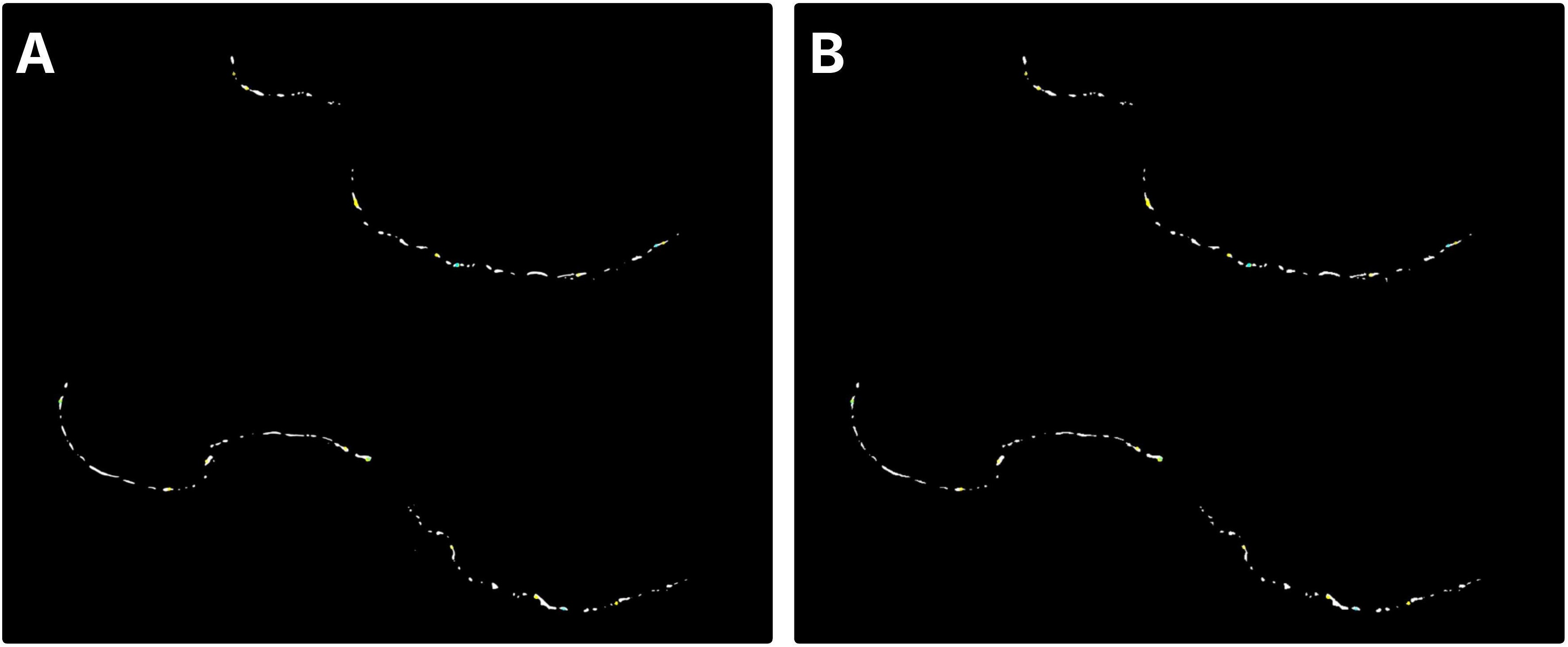 Automated Histopathologic Assessment of Hirschsprung Disease Using a ...